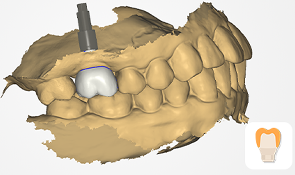 UPCAD – Smarter, Intuitive Dental CAD | UP3D